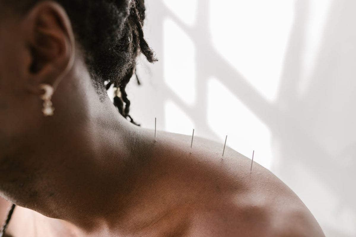 Understand Acupuncture: What is it and how does it work – The Herb Depot